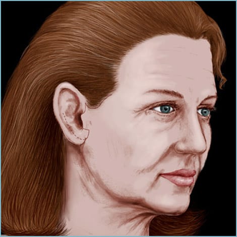 Facelift Surgery Incisions in Denver | The Center for Cosmetic Surgery